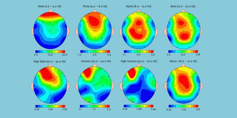 Gehirnwellen als Biomarker - Das Quantitative EEG (QEEG) in der ...